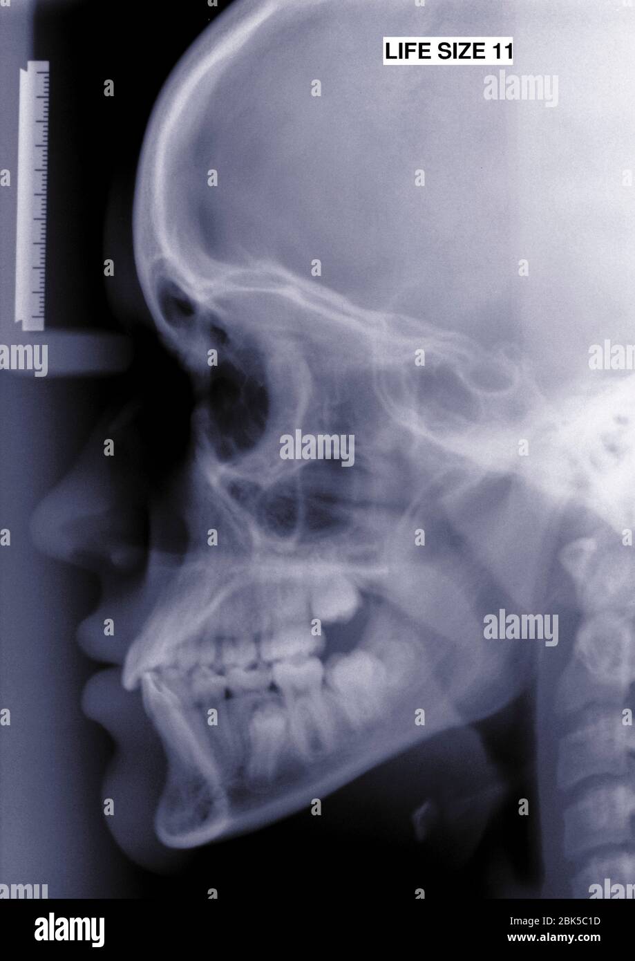 Skull and face, X-ray Stock Photo - Alamy