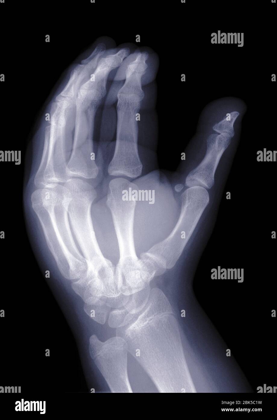 Human wrist anatomy xray view hi-res stock photography and images - Alamy