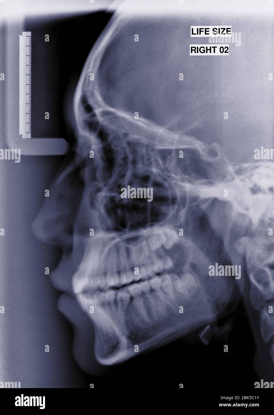 Skull and face, X-ray Stock Photo - Alamy