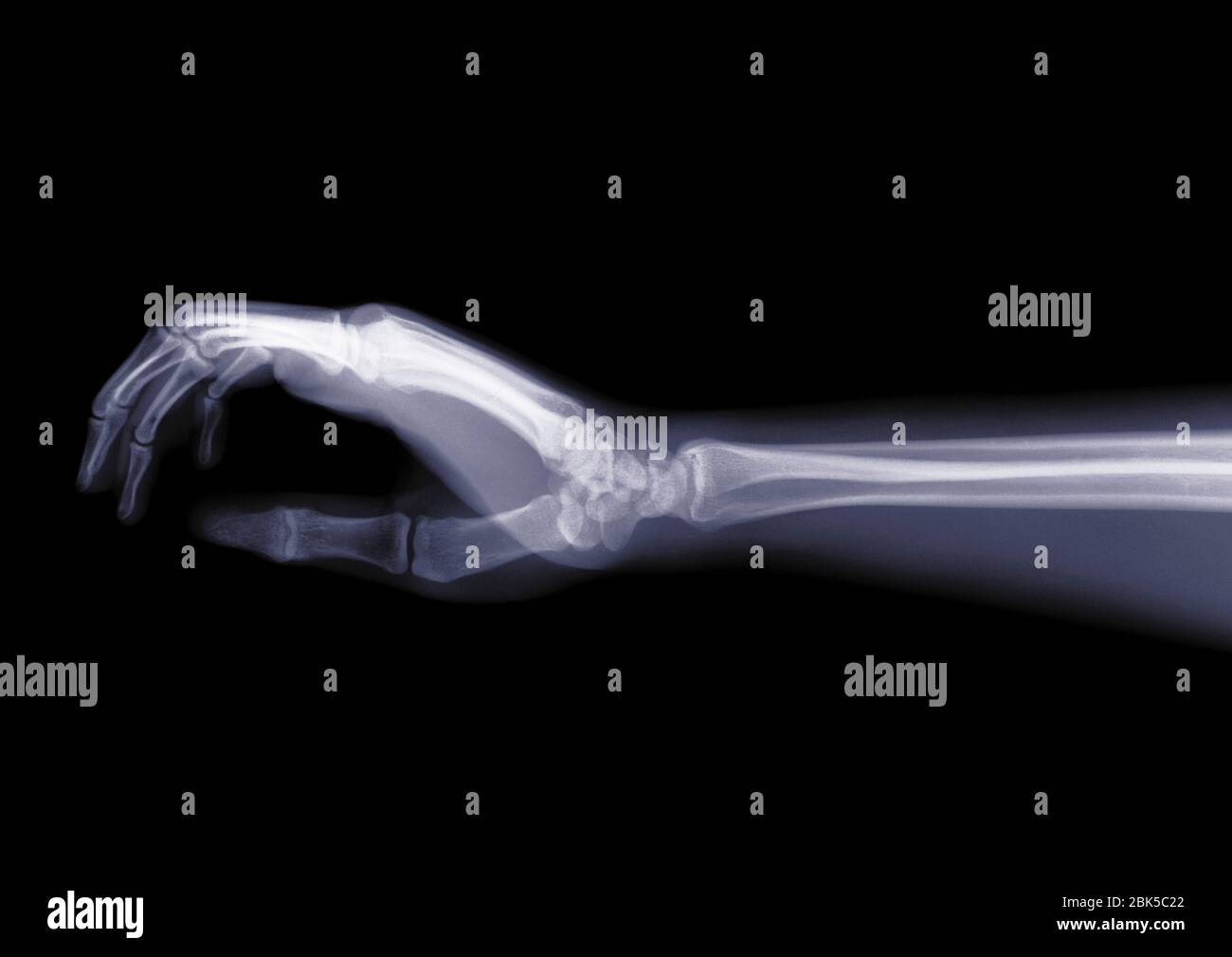 Arm and hand in profile, X-ray Stock Photo - Alamy