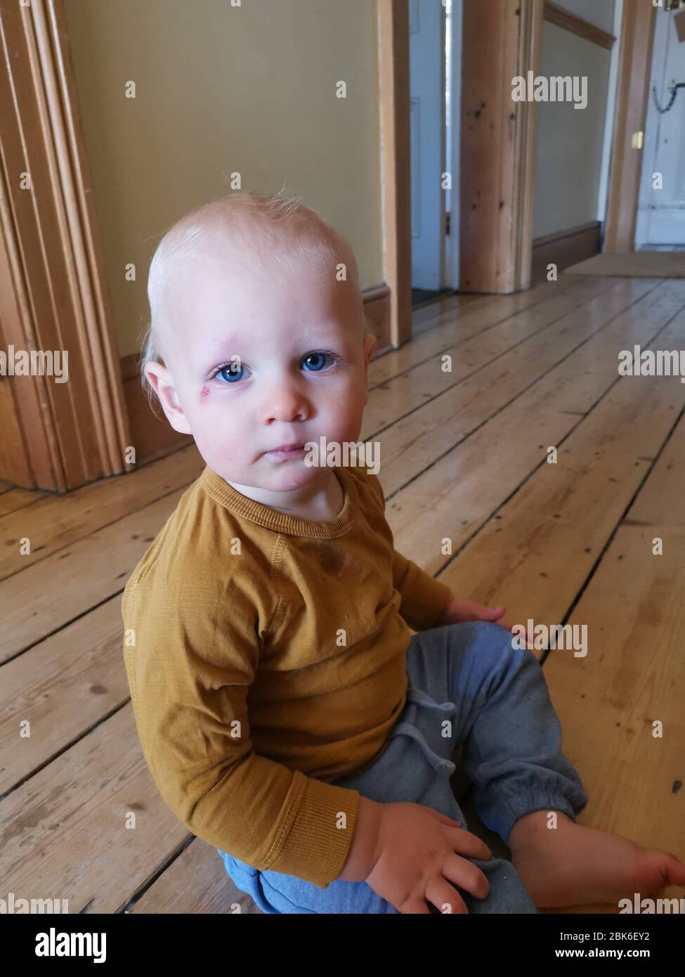 Bruise High Resolution Stock Photography and Images - Alamy