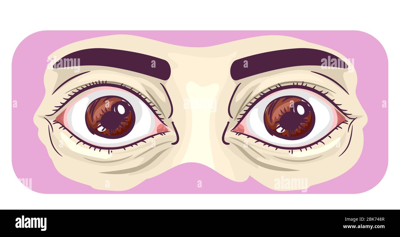 Illustration of Bulging Eyes with Both Eyes Protruding Stock Photo - Alamy