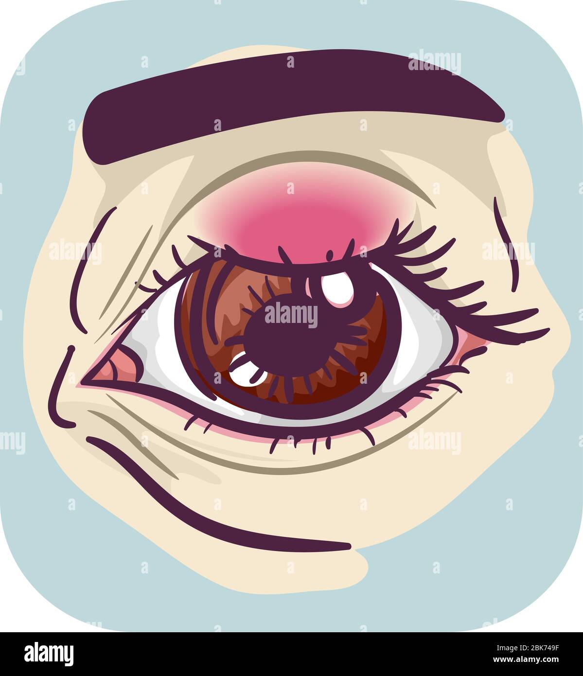 Illustration of Chalazion in One Eye Stock Photo - Alamy