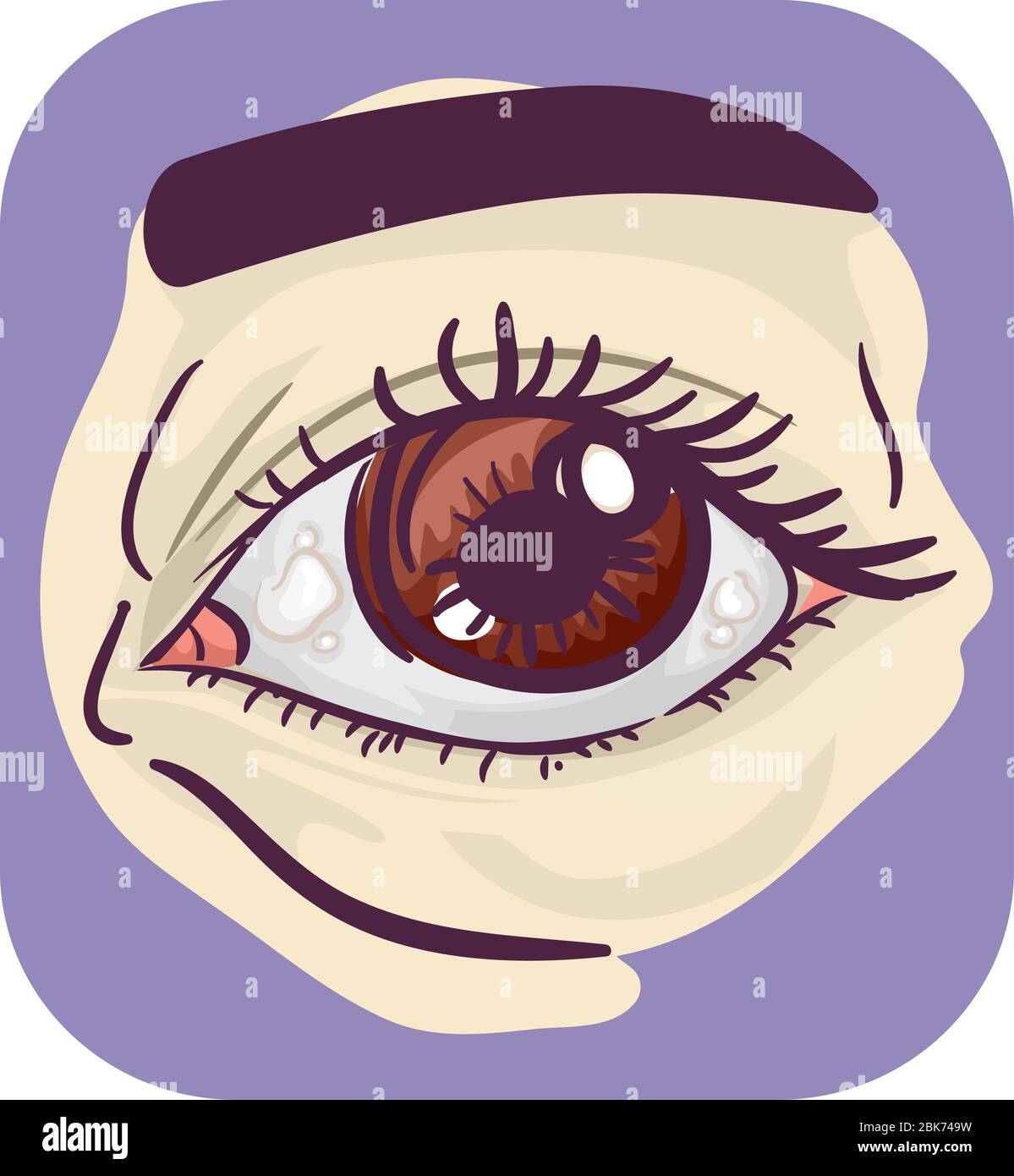Illustration of an Eye with Bump on Cornea Symptom of Pterygium Stock ...