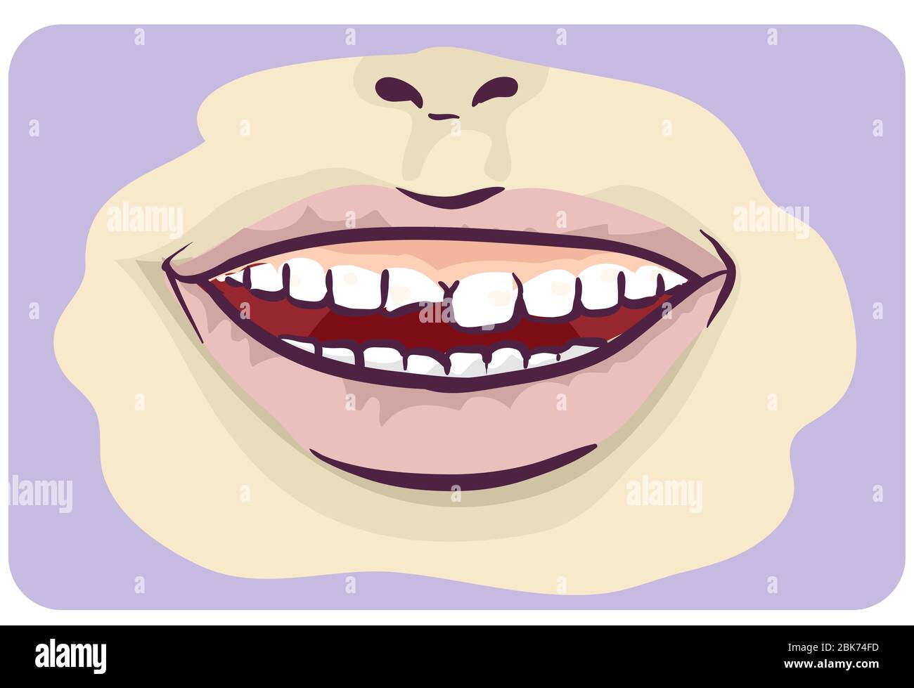 Illustration of an Open Mouth with Chipped Tooth Symptom of Decay Stock ...