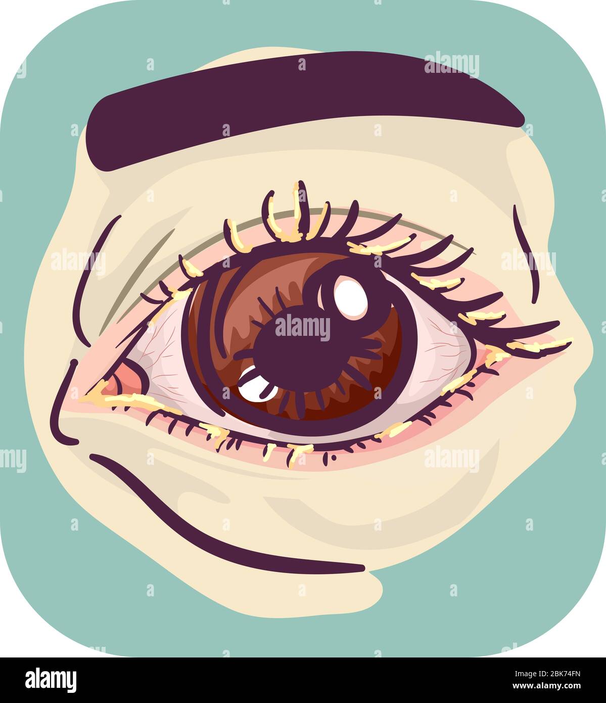 Illustration of Crusty Eye Symptom of Blepharitis Stock Photo - Alamy