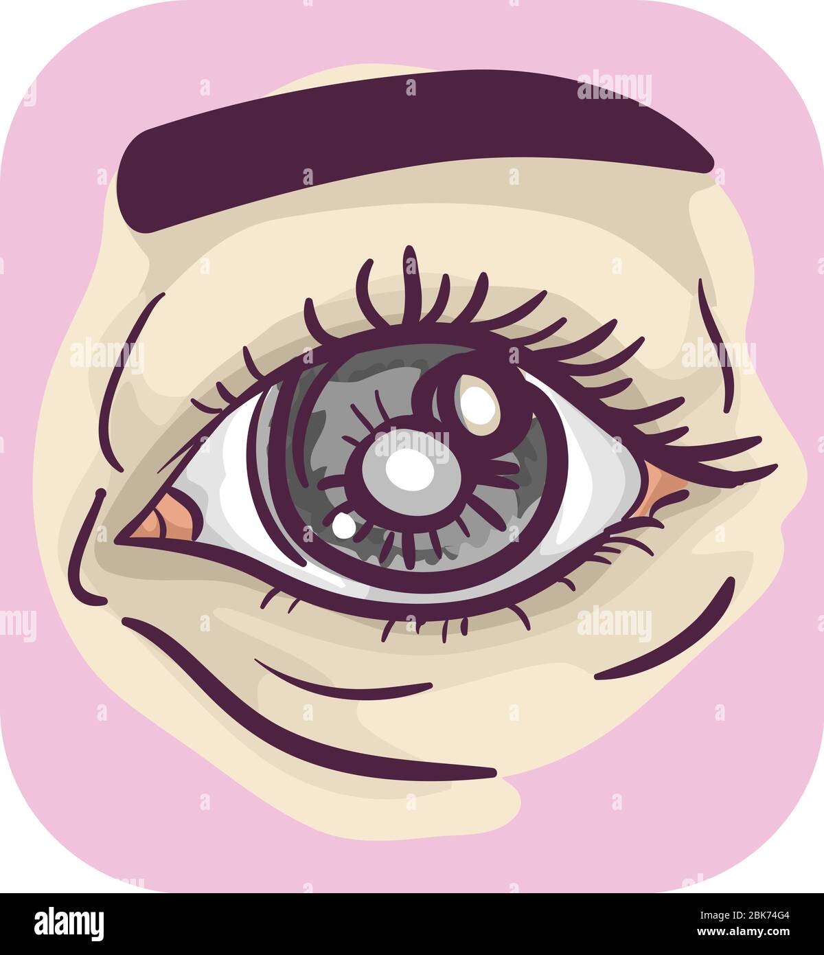 Illustration of an Eye with Hazy Pupil Symptom of Glaucoma Stock Photo ...