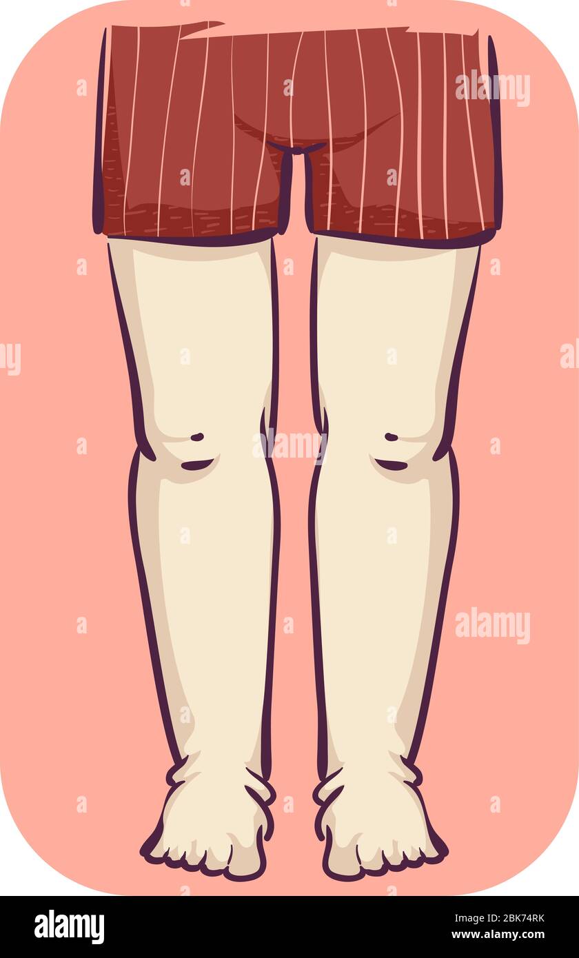 Illustration of a Girl Standing with Swollen Legs Stock Photo - Alamy