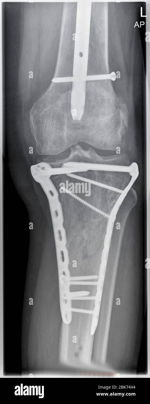 X-ray image of multiple fractures after a traffic accident Stock Photo ...