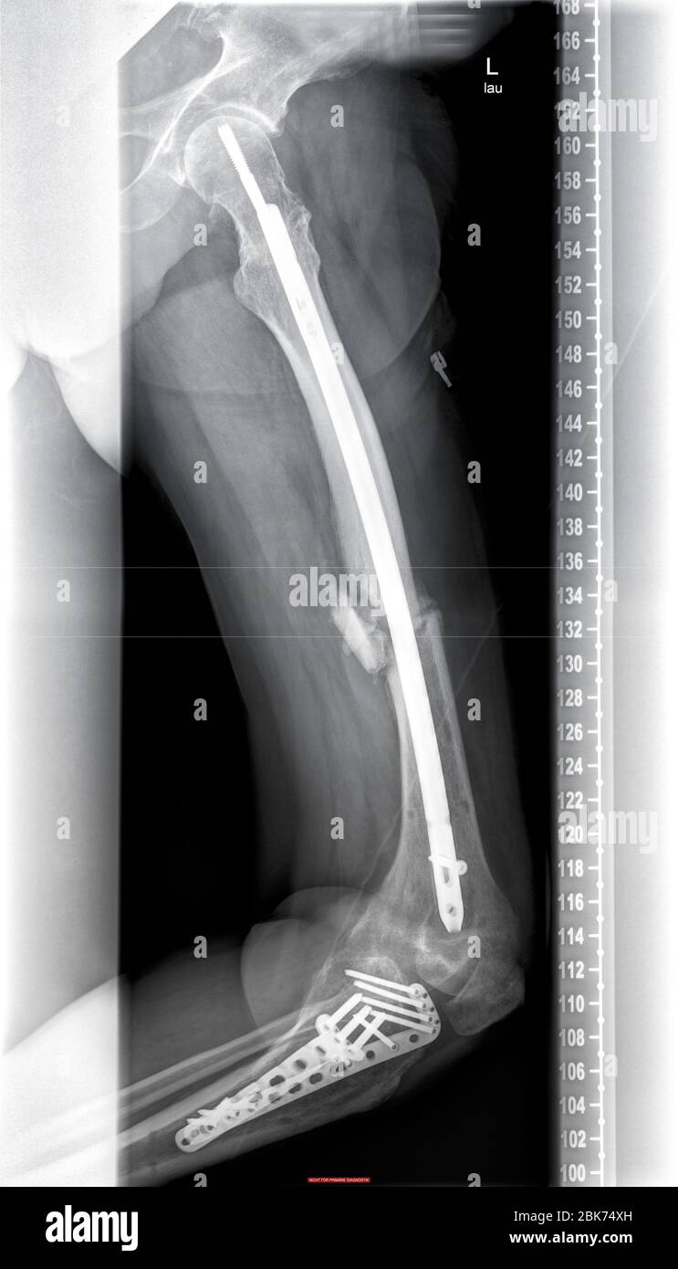 X-ray image of multiple fractures after a traffic accident Stock Photo ...