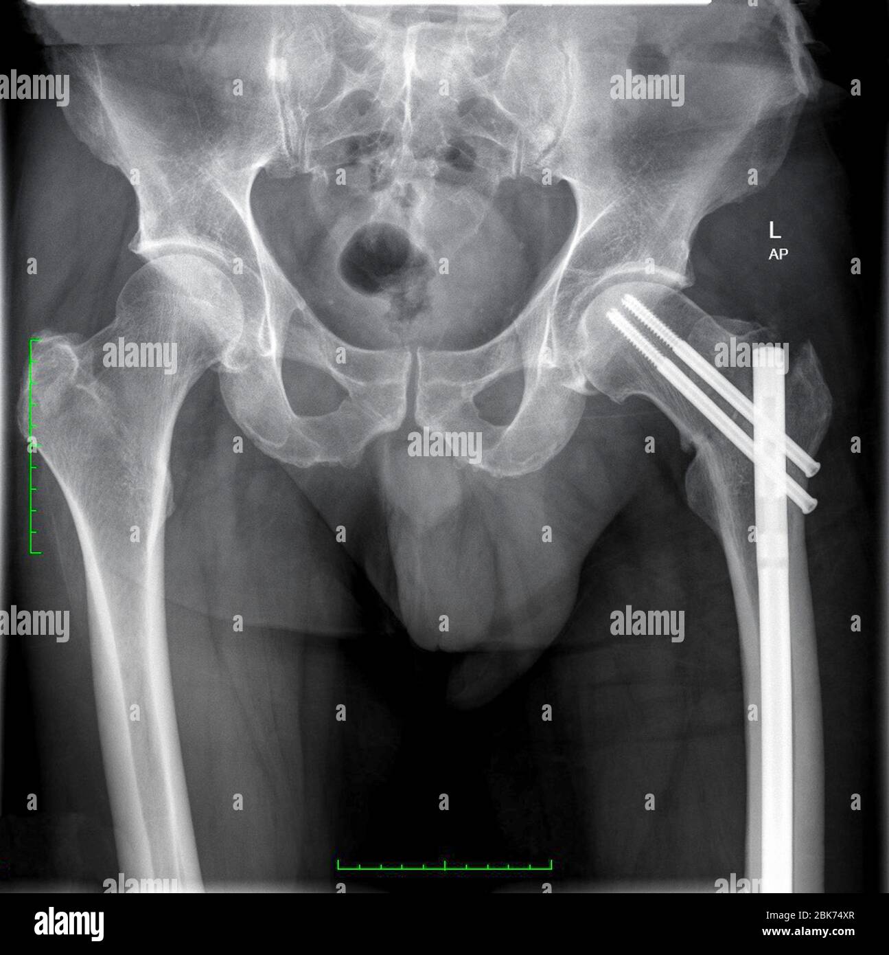 X-ray image of multiple fractures after a traffic accident Stock Photo ...