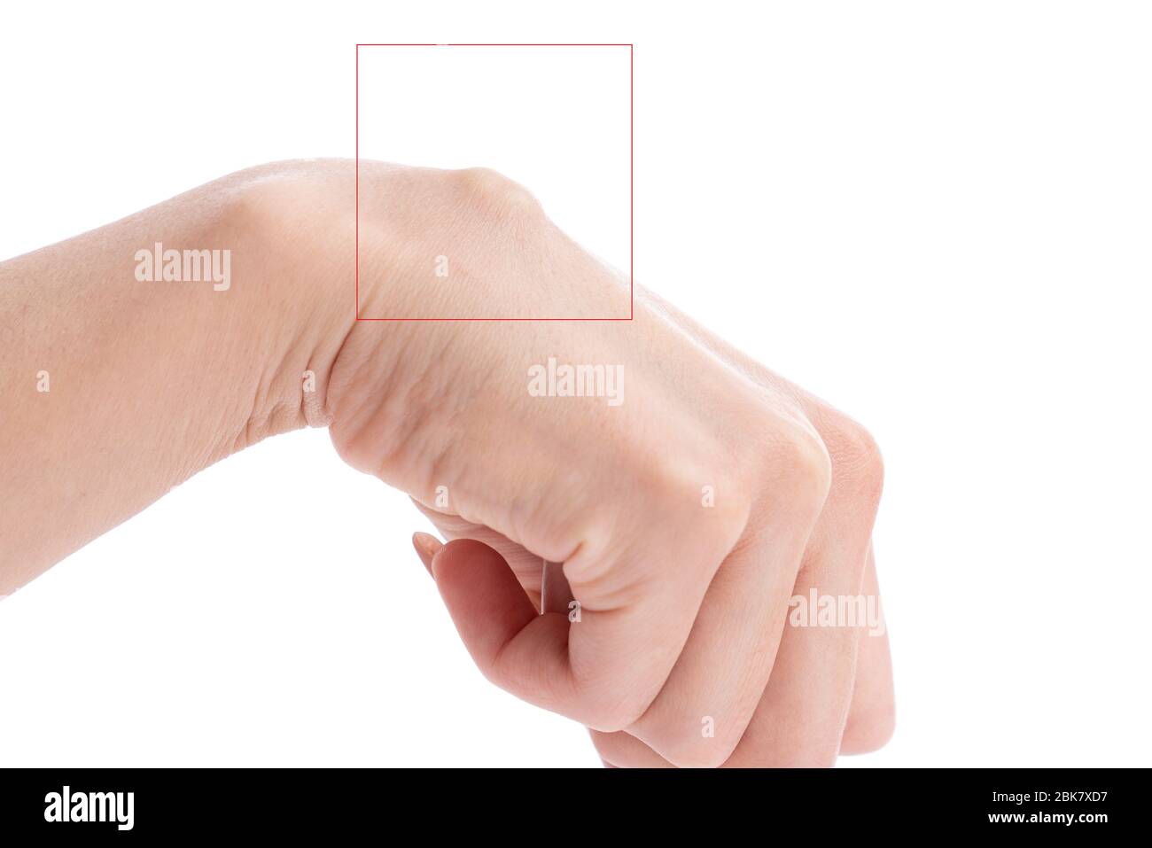 Females hand with big cyst hygroma circled in red square isolated on ...