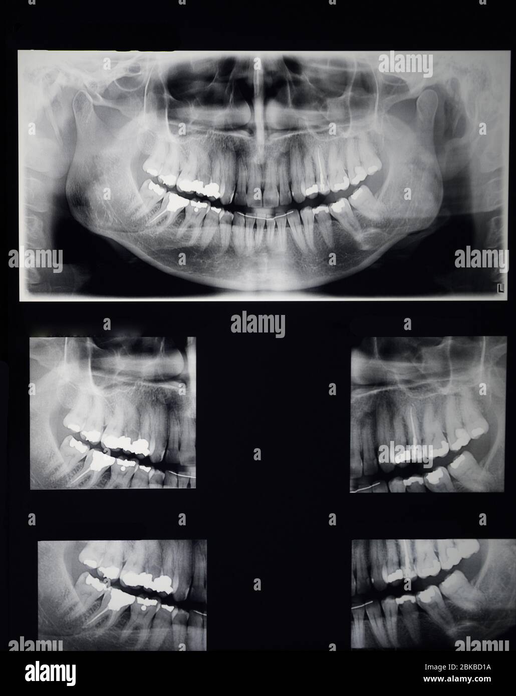 Maxillary radiographs hi-res stock photography and images - Alamy