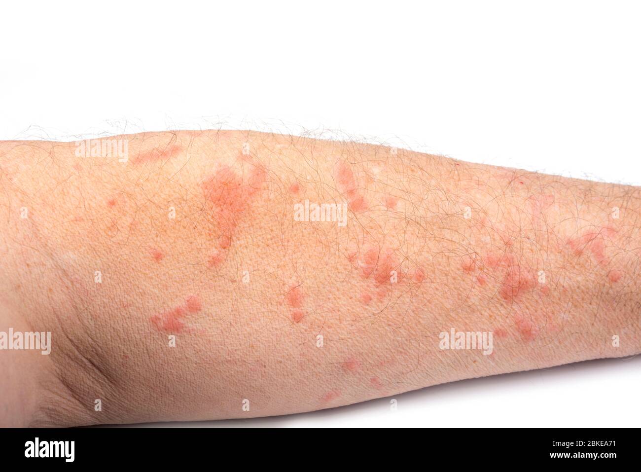 Rash red lesions on hi-res stock photography and images - Alamy