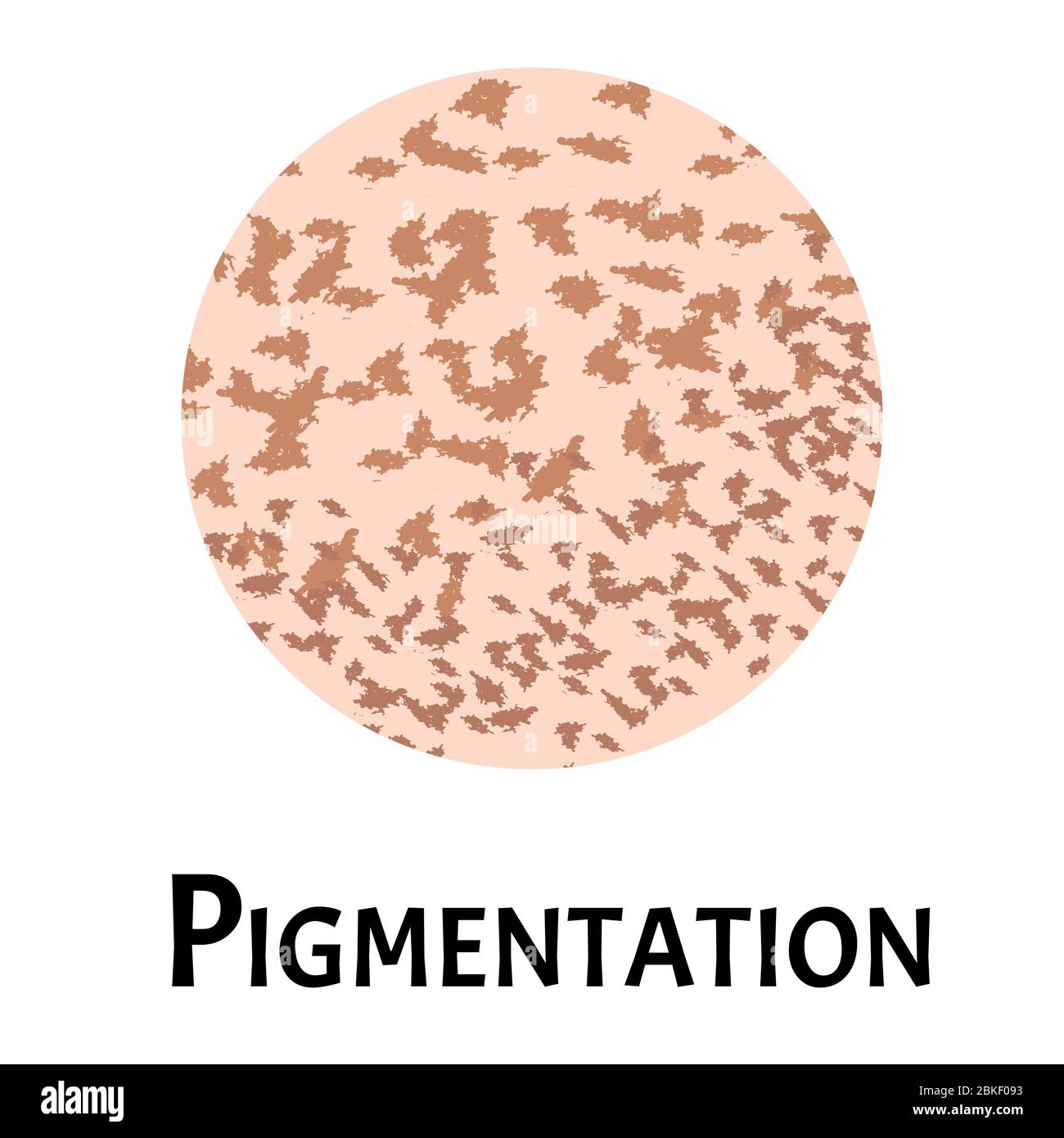 Pigmentation on the skin. A pigmented spot on the skin of the face ...