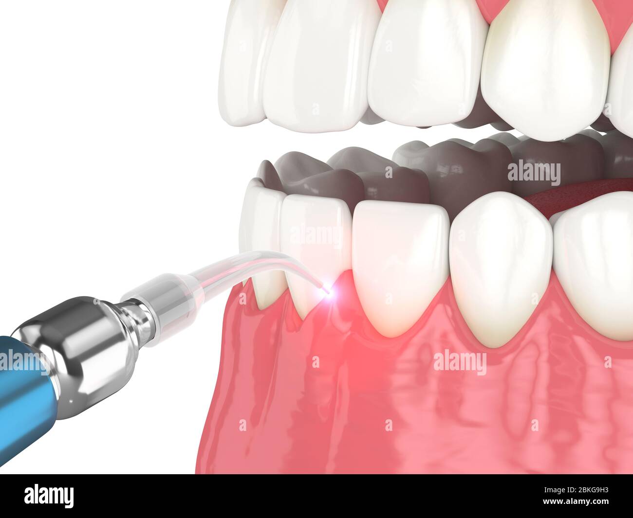 3d render of dental diode laser used to treat gums. The concept of ...