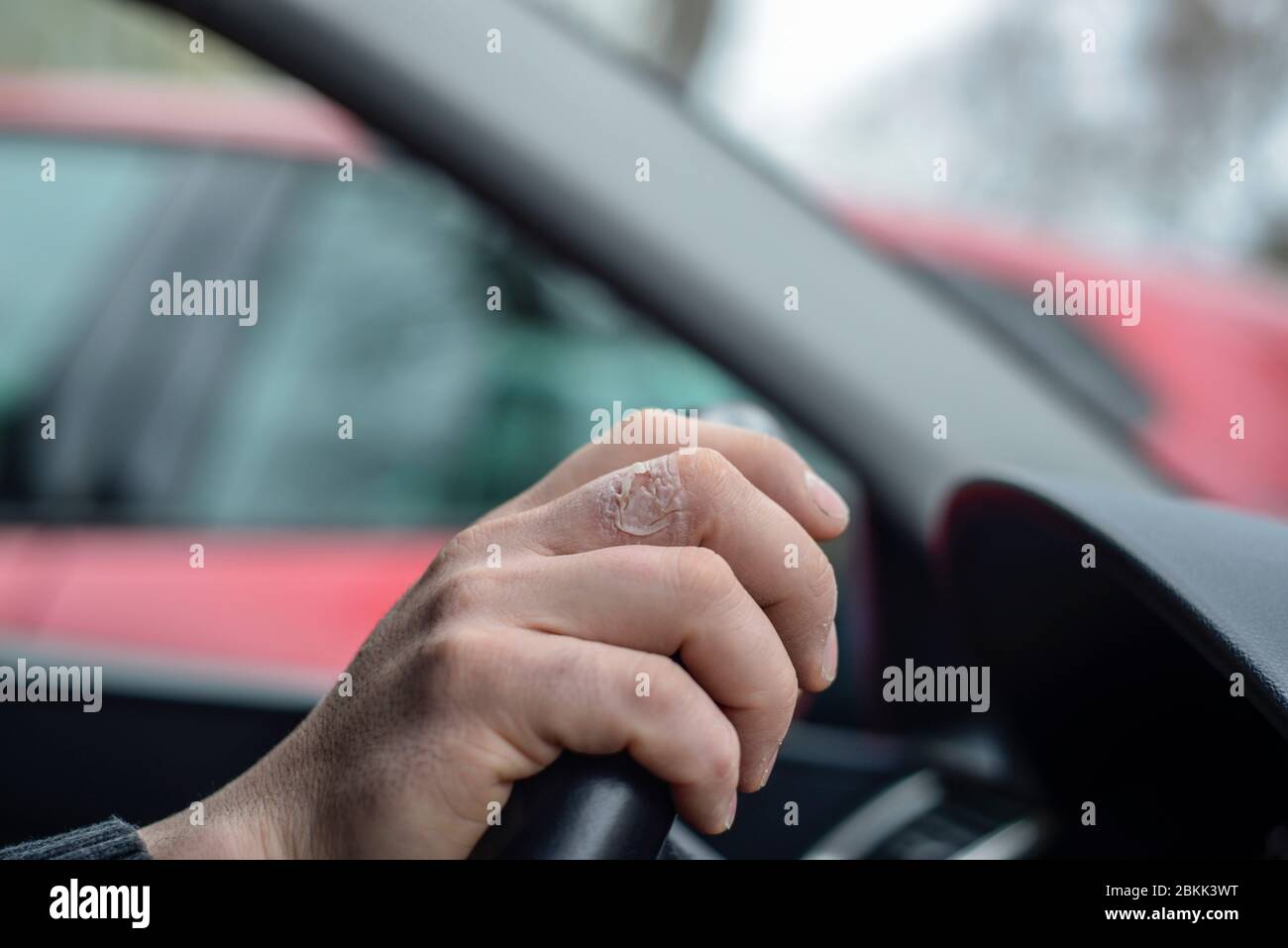 Burning pain. Wound from burn work accident on man's hand, driving to ...