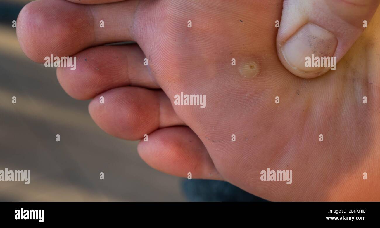 Verruca foot hi-res stock photography and images - Alamy