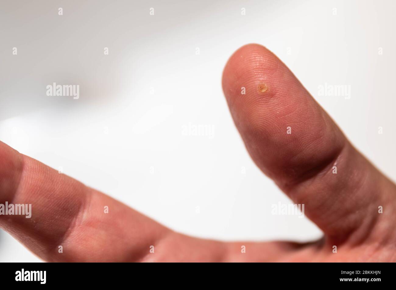 Verruca Free Stock Photos, Images, And Pictures Of Verruca, 57% OFF