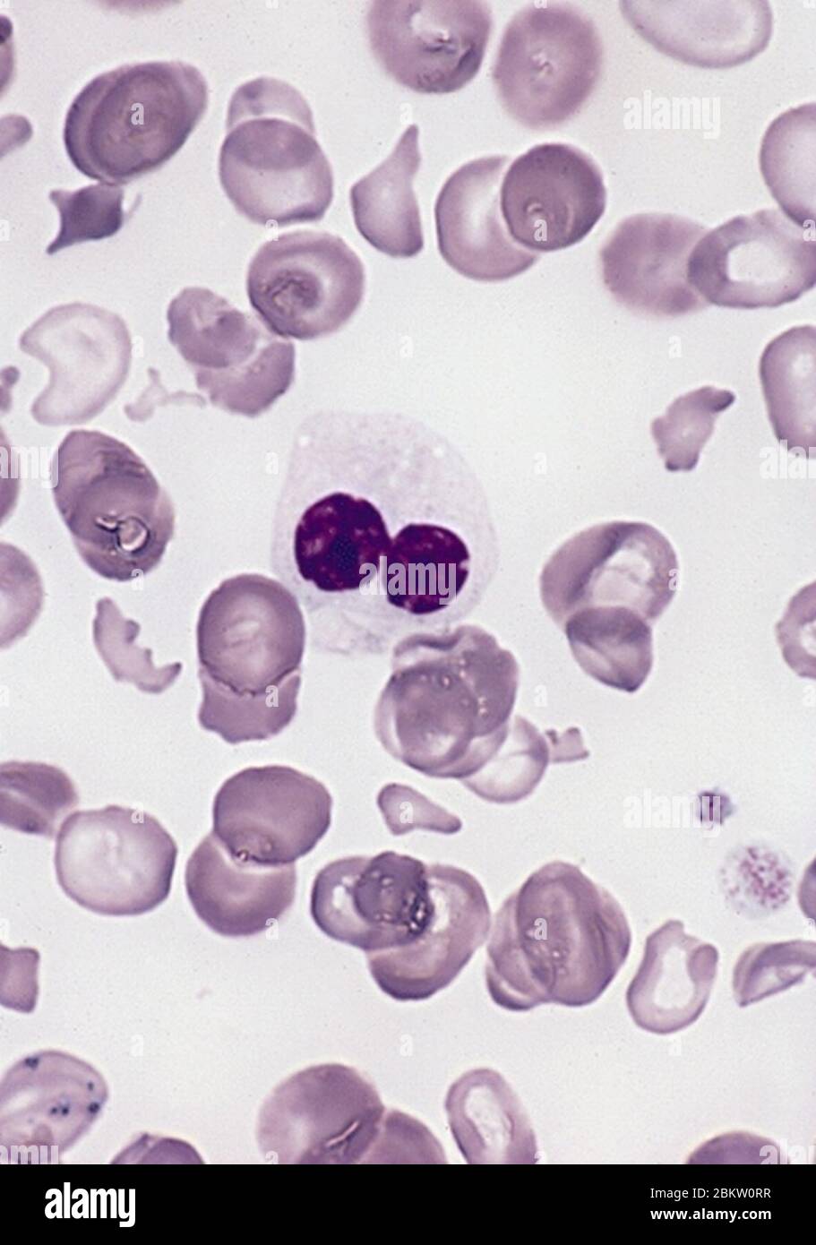 Hypogranular neutrophil with a pseudo-Pelger-Huet nucleus in MDS Stock ...