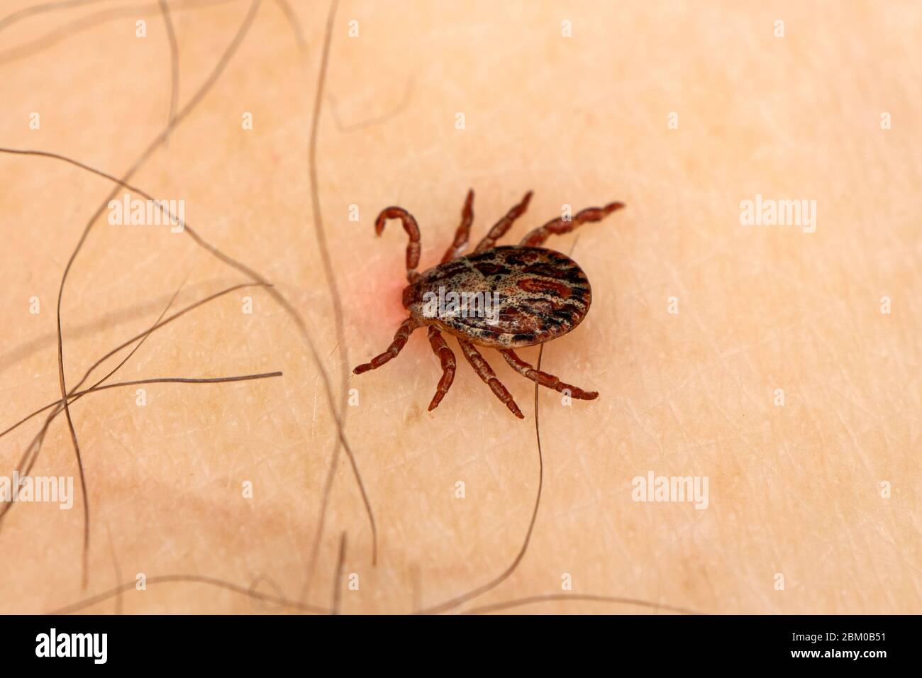 Bloodsucking tick on human hi-res stock photography and images - Alamy