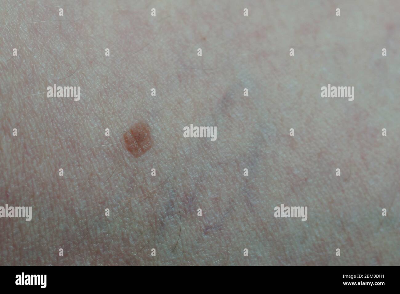 Malignant melanoma cell hi-res stock photography and images - Alamy