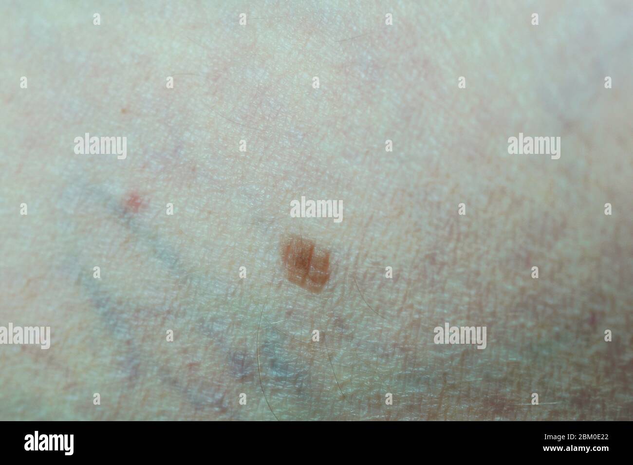 Basal cell skin cancer hi-res stock photography and images - Alamy