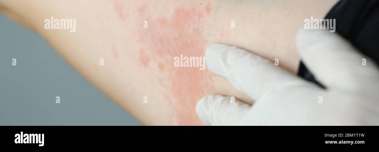 Skin rash hi-res stock photography and images - Alamy
