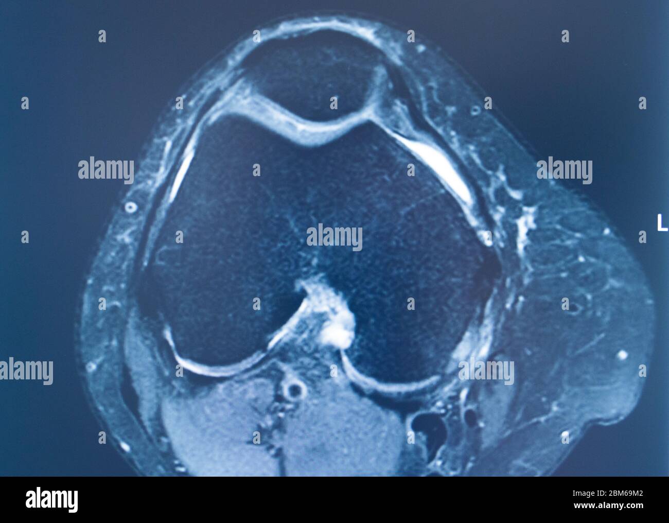 Knee sports injury mri mcl grade 2 tear magnetic resonance imaging ...