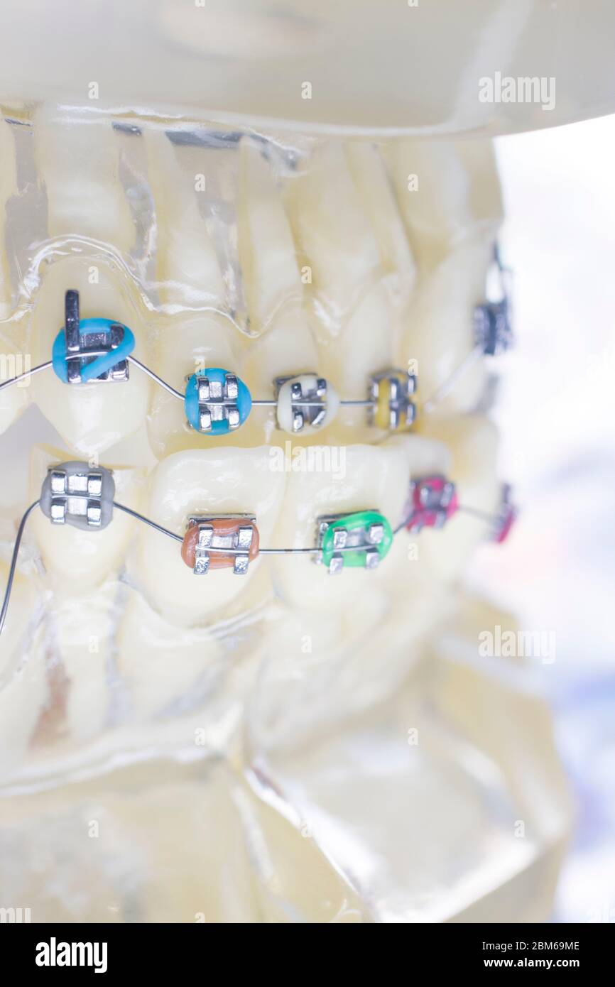 Modern metal retainers and plastic algners wire dental brackets teeth ...