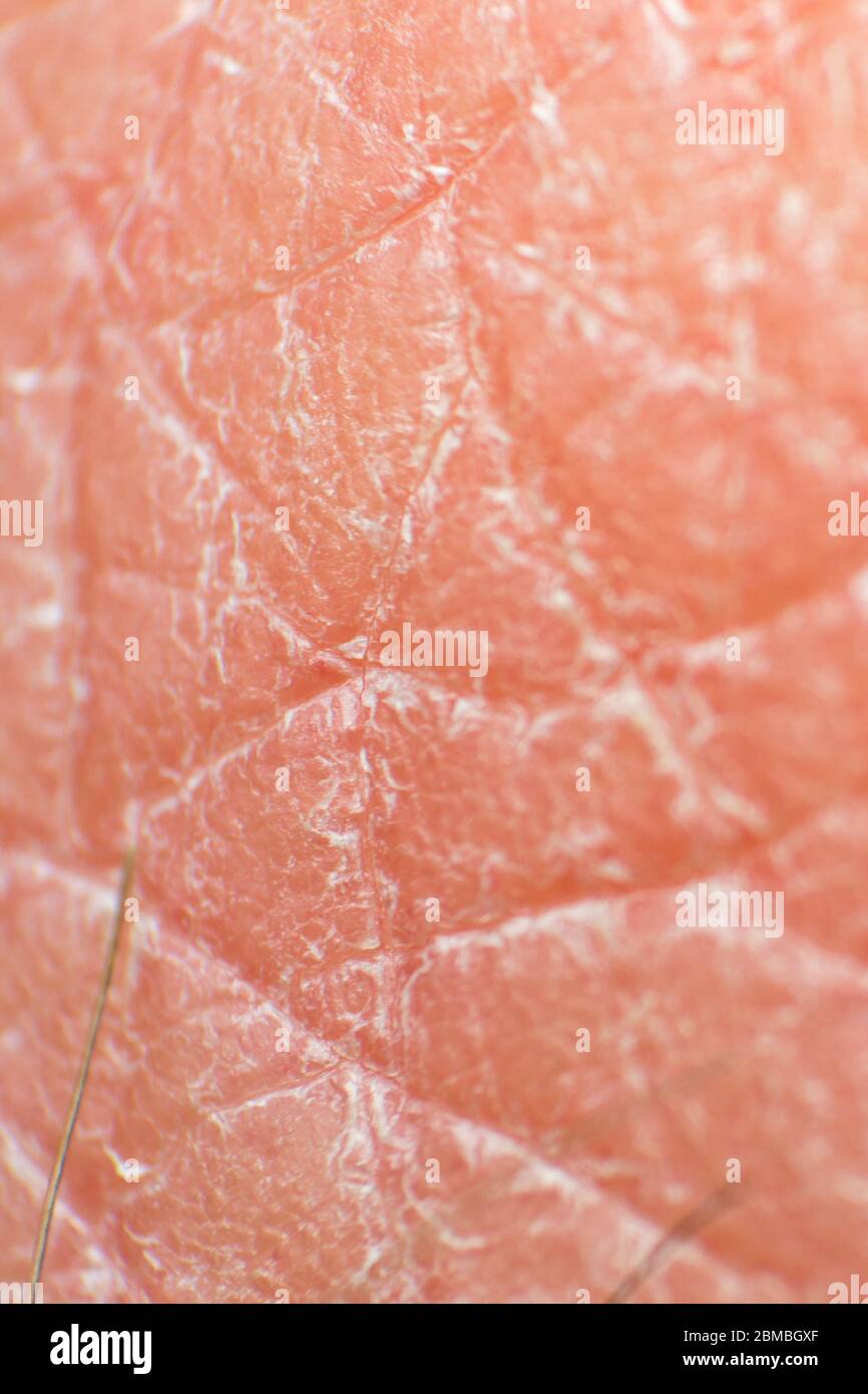 macro photo of dry human skin after frequent washing hands with soap ...