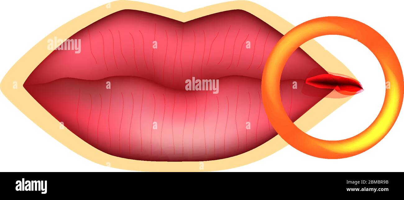Cracks at the corners of the lips. Dry chapped lips. Wounds in the ...
