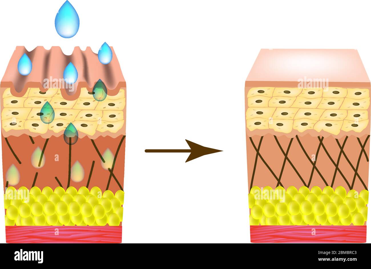 Wrinkles on the skin. Collagen deficiency. Impact on the skin with a ...