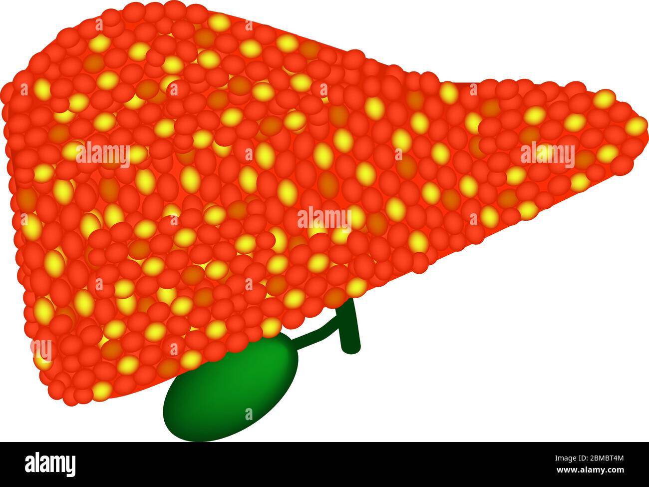 Cirrhosis of the liver. Infographics. Vector illustration on isolated ...