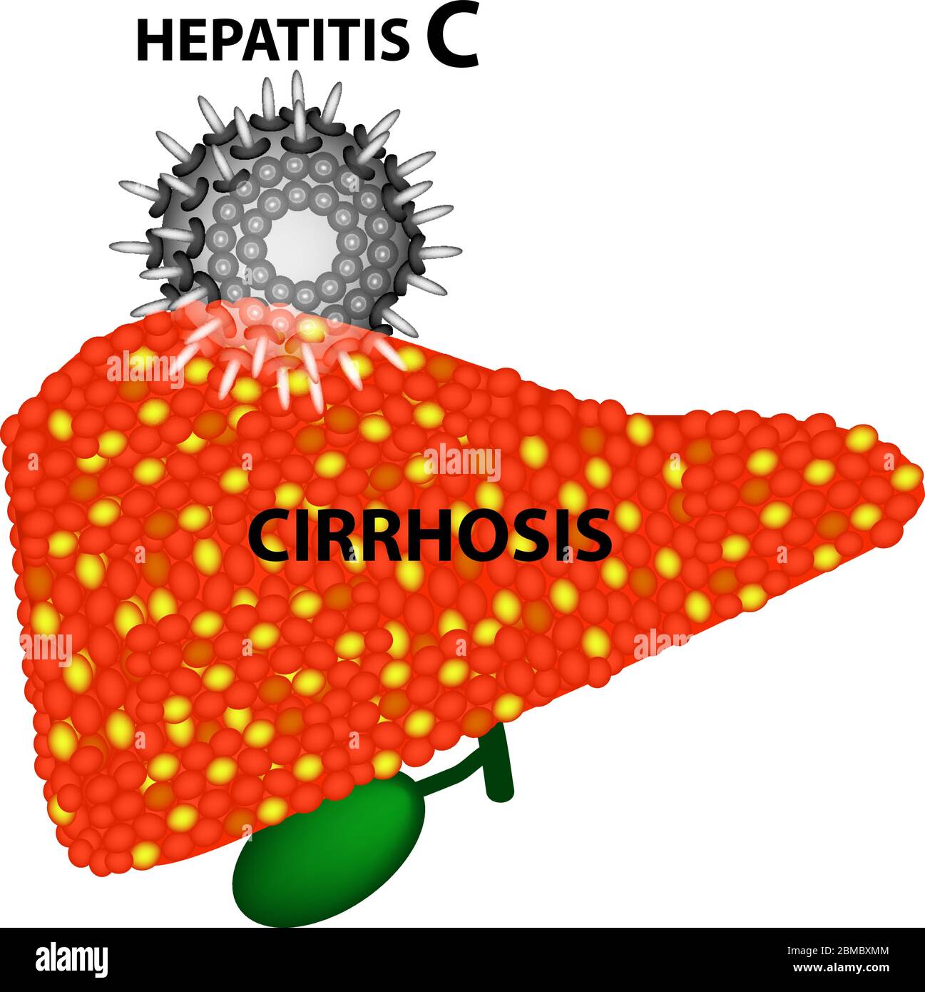 Hepatitis C leads to the development of cirrhosis in 97 percent of ...