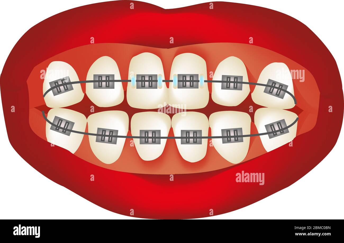 Braces On The Teeth Infographics Vector Illustration On Isolated
