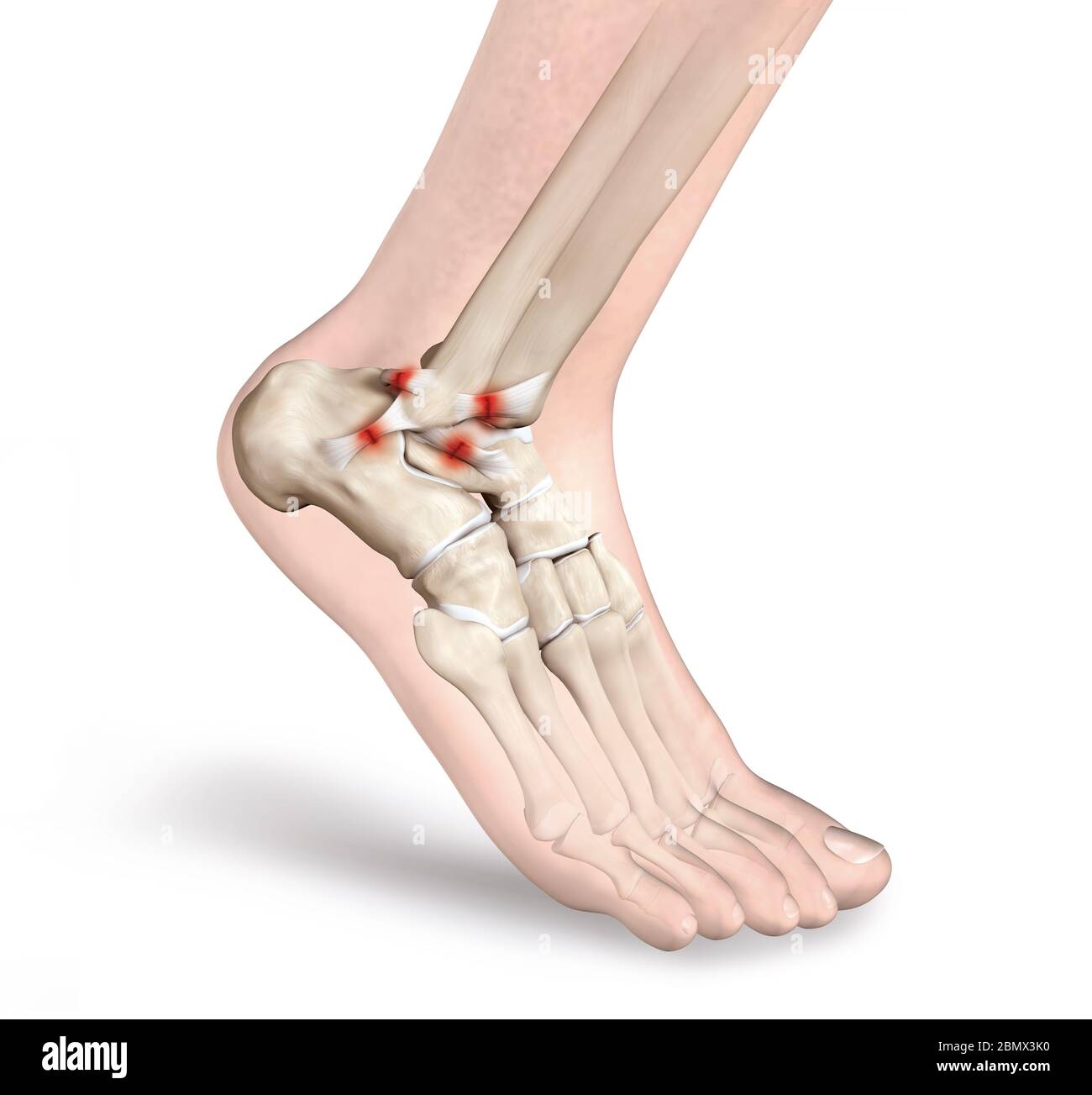 3D illustration showing rupture of a ligament in ankle joint Stock ...