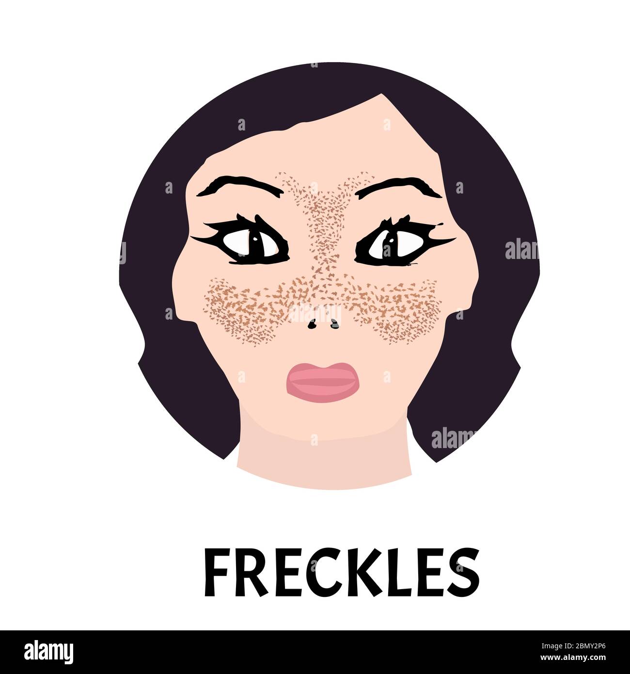 Freckles on the face. Pigmentation on the skin. A pigmented spot on the ...