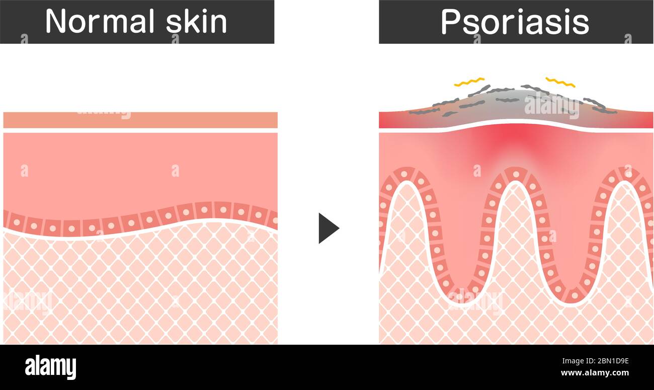 Cross section of psoriasis and normal skin / flat vector illustration ...