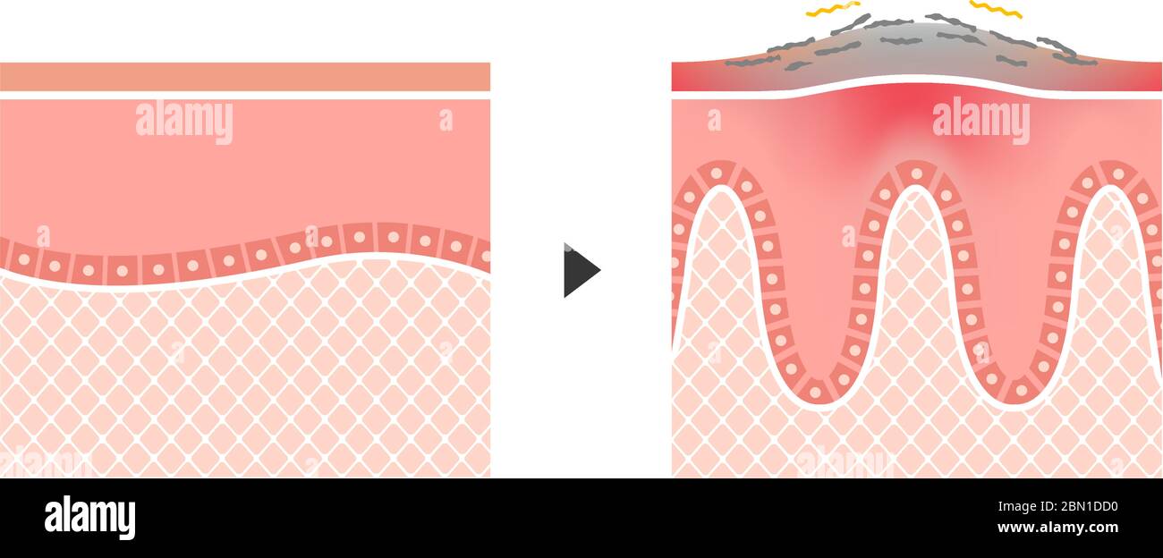 Cross section of psoriasis and normal skin / flat vector illustration ...