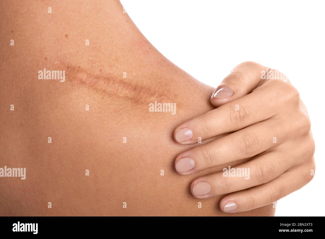 Surgery shoulder incision hi-res stock photography and images - Alamy