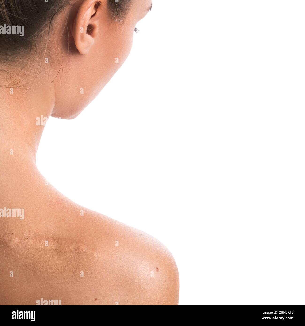 Surgery shoulder incision hi-res stock photography and images - Alamy