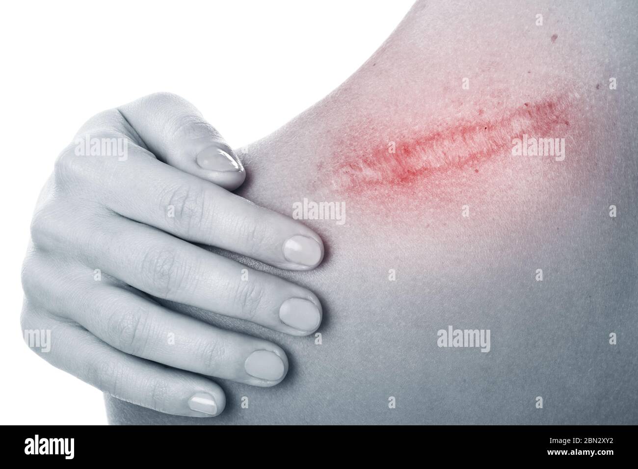Surgery shoulder incision hi-res stock photography and images - Alamy