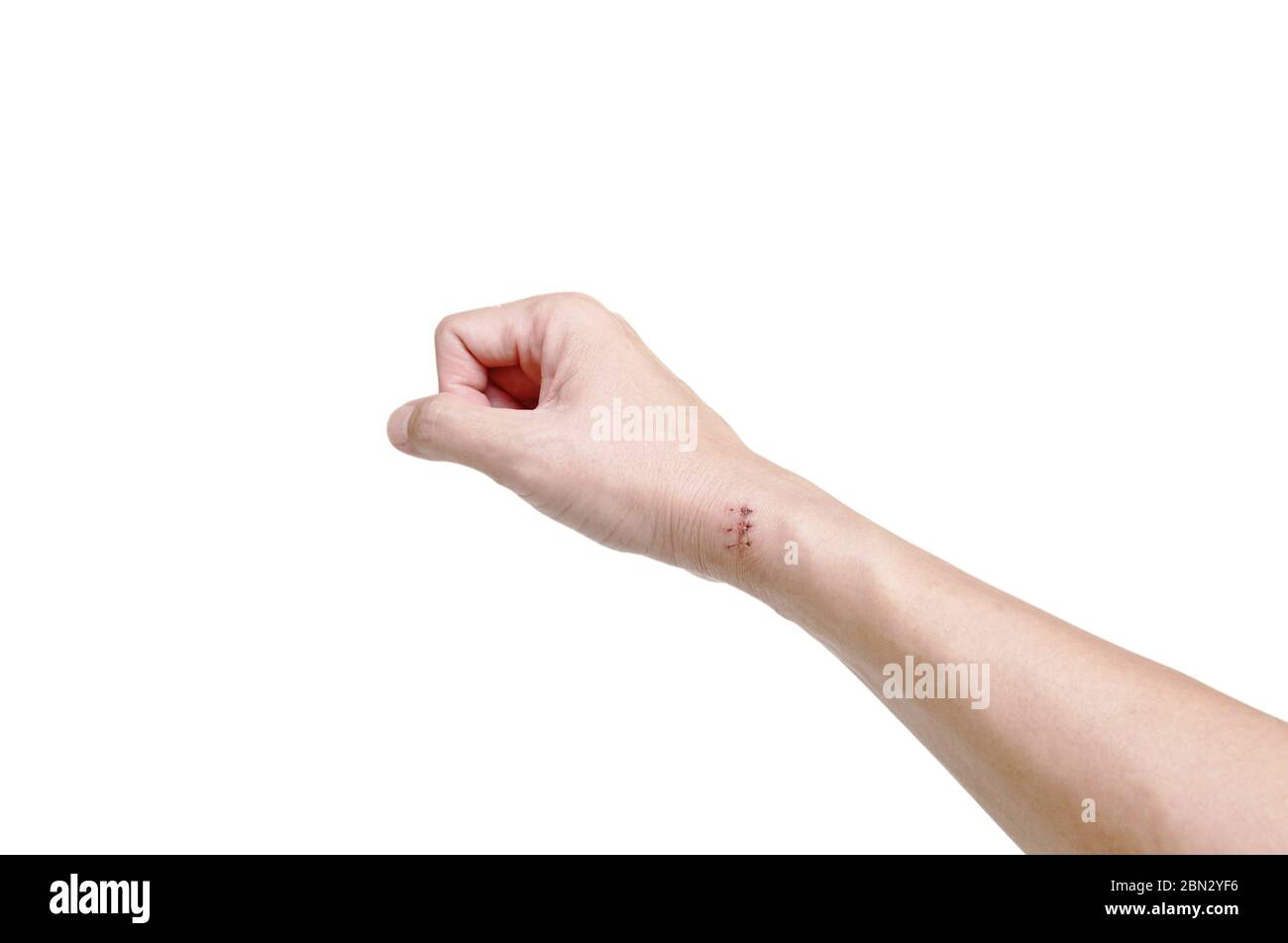hand with suture scar after surgery on white background Stock Photo - Alamy