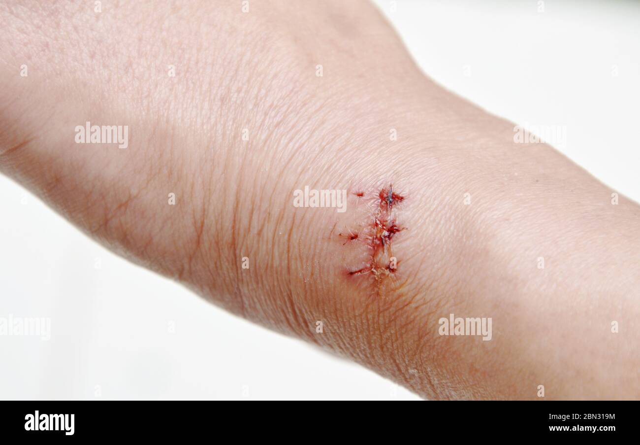 hand with suture scar after surgery on white background Stock Photo - Alamy