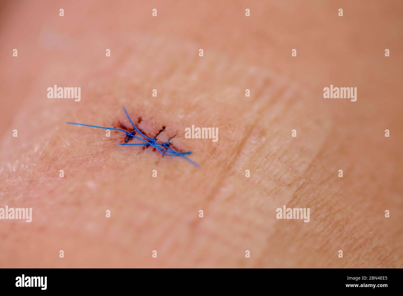 Surgeon biopsy cancer hi-res stock photography and images - Alamy
