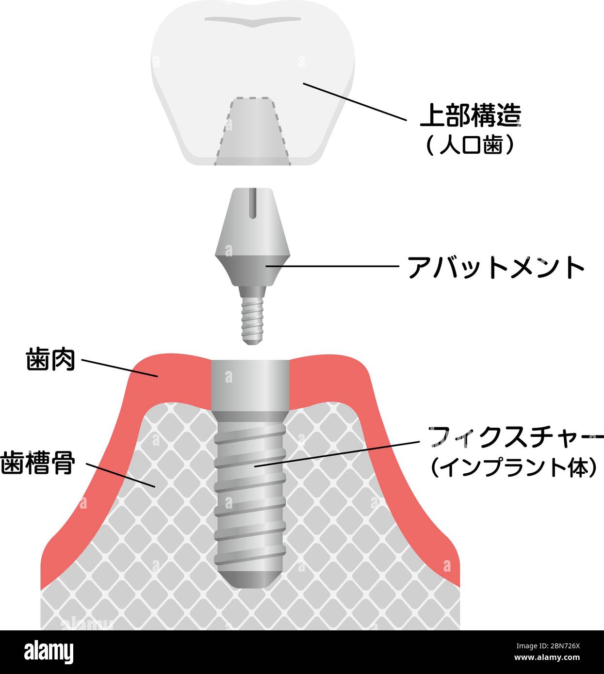 Dental implant flat vector illustration Stock Vector Image & Art - Alamy