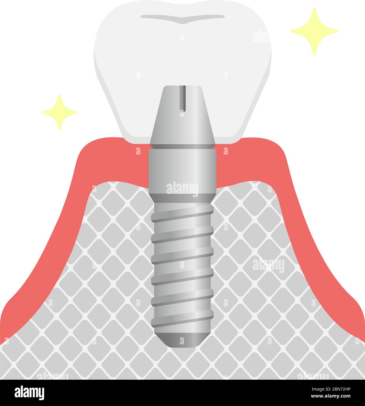 Dental implant flat vector illustration / Set artificial teeth (crown ...
