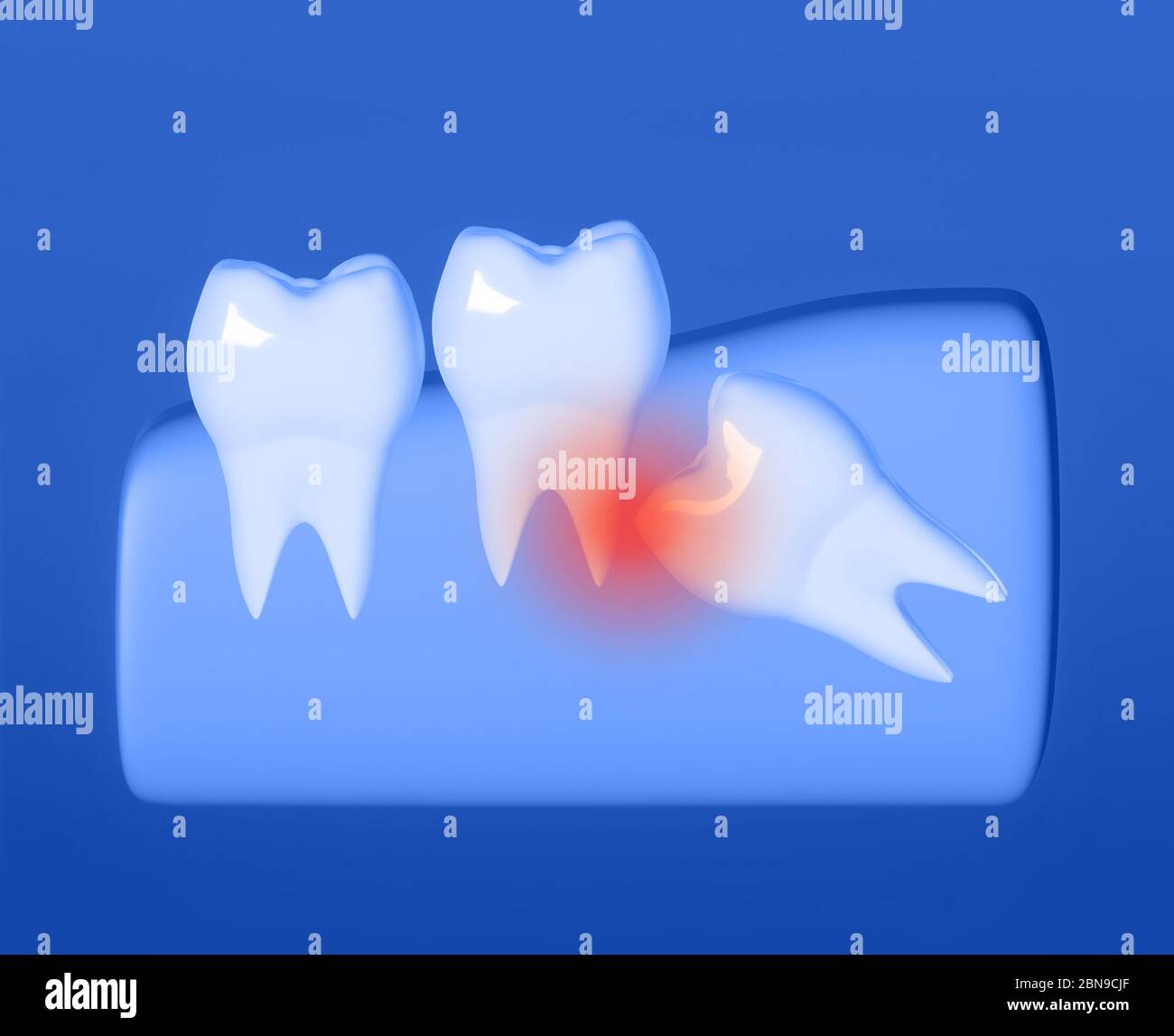 Wisdom tooth grows wrong, wisdom tooth problem, horizontal position of ...