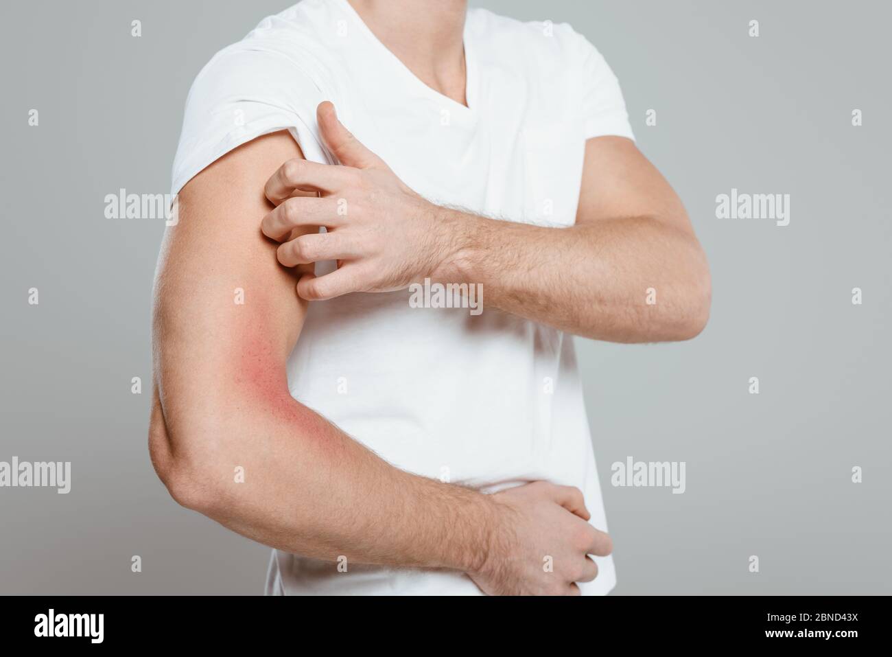 Partial view of man scratching hand with allergy isolated on grey Stock ...
